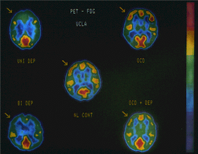 There Are No "Chemical Imbalances"